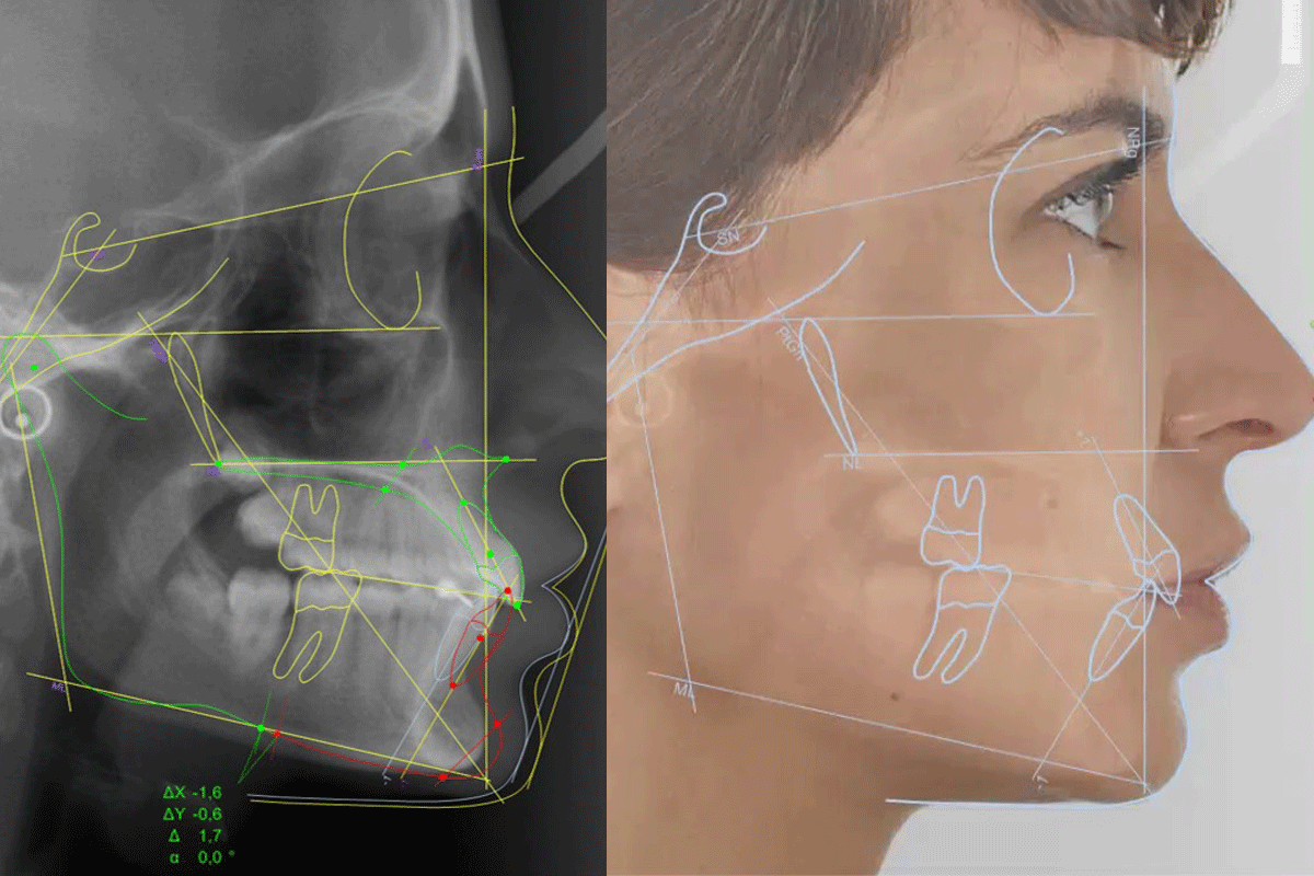 Røntgen | Romexis Ceph Analysis