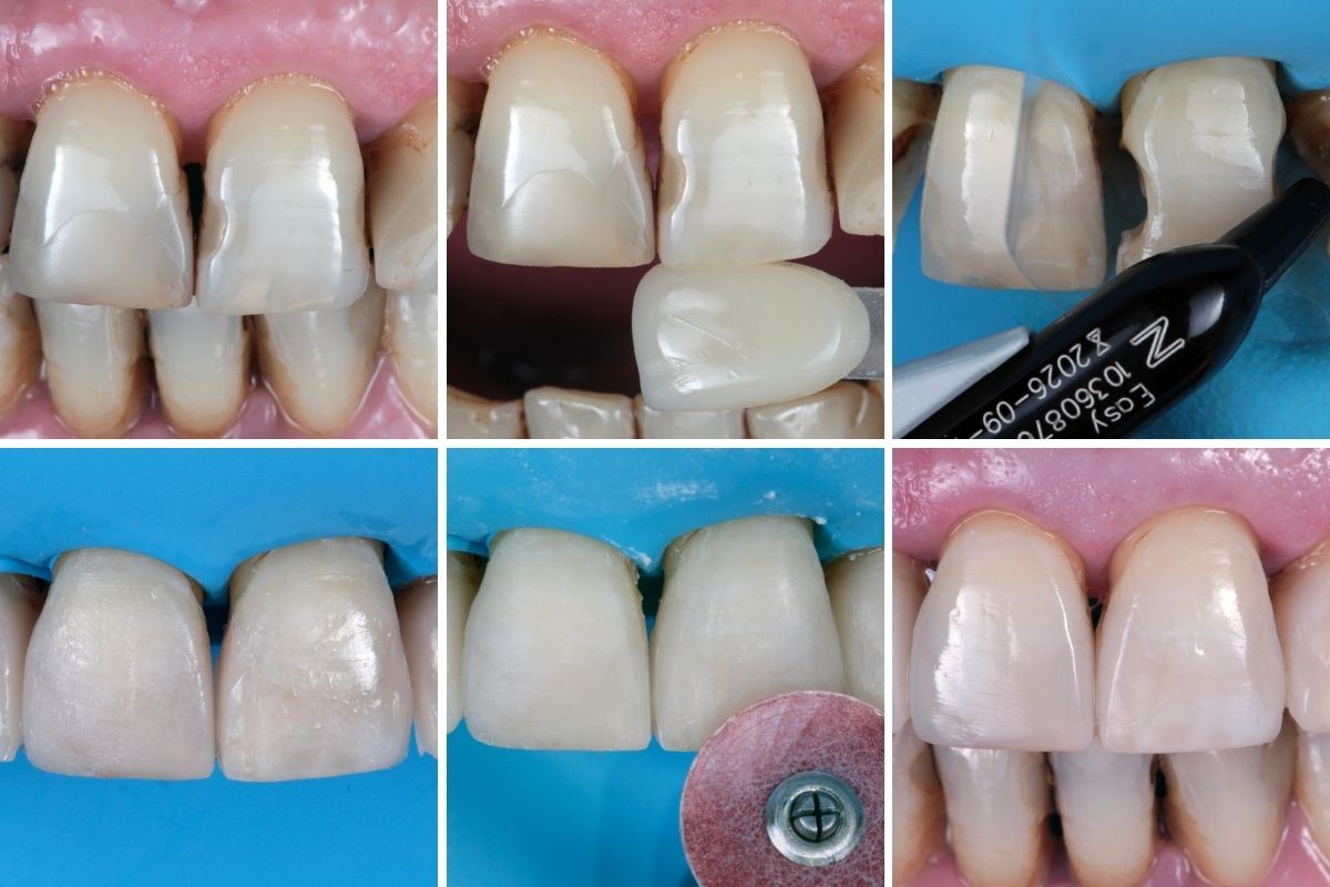 Forenklet fargevalg til komposittfyllinger